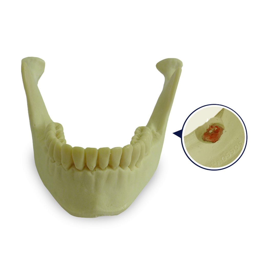 MANDÍBULA COM DENTE 38 INCLUSO - ODONTOLOGIA