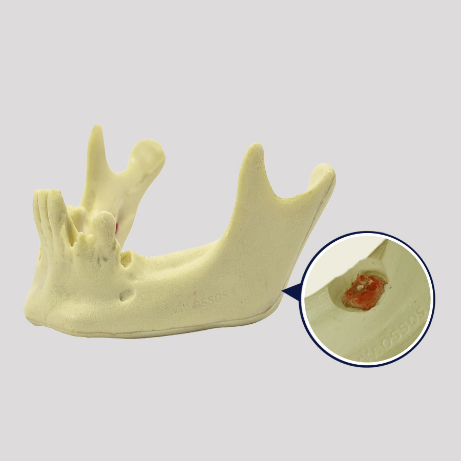 MANDIBULA COM 3º MOLAR INCLUSO - ODONTOLOGIA